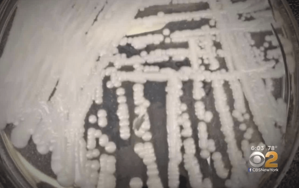 Superbug infections could kill 2 million a year in 2050 - Headline Health