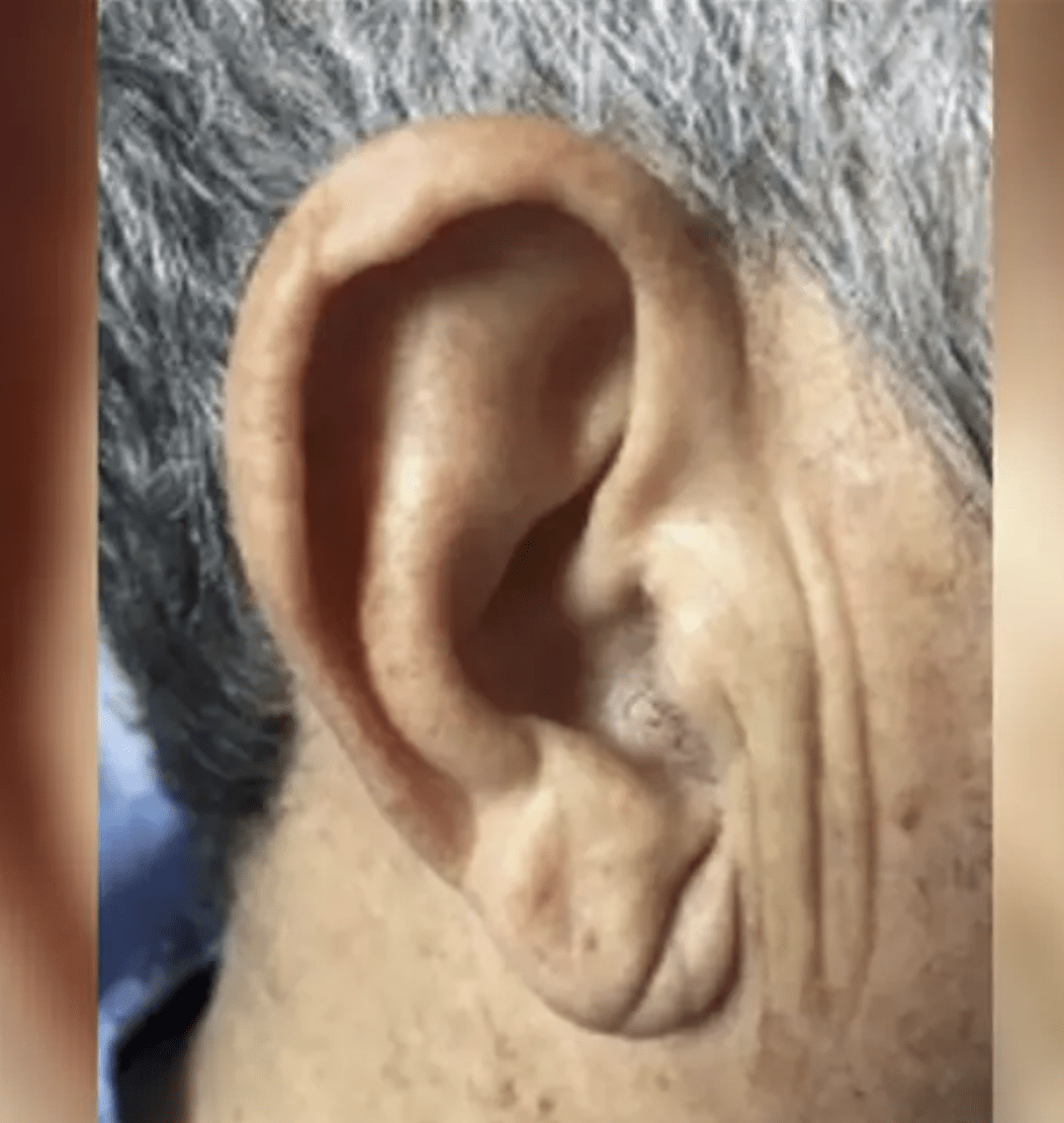 If You Have This Weird Line On Your Earlobe, What Does It Mean ...