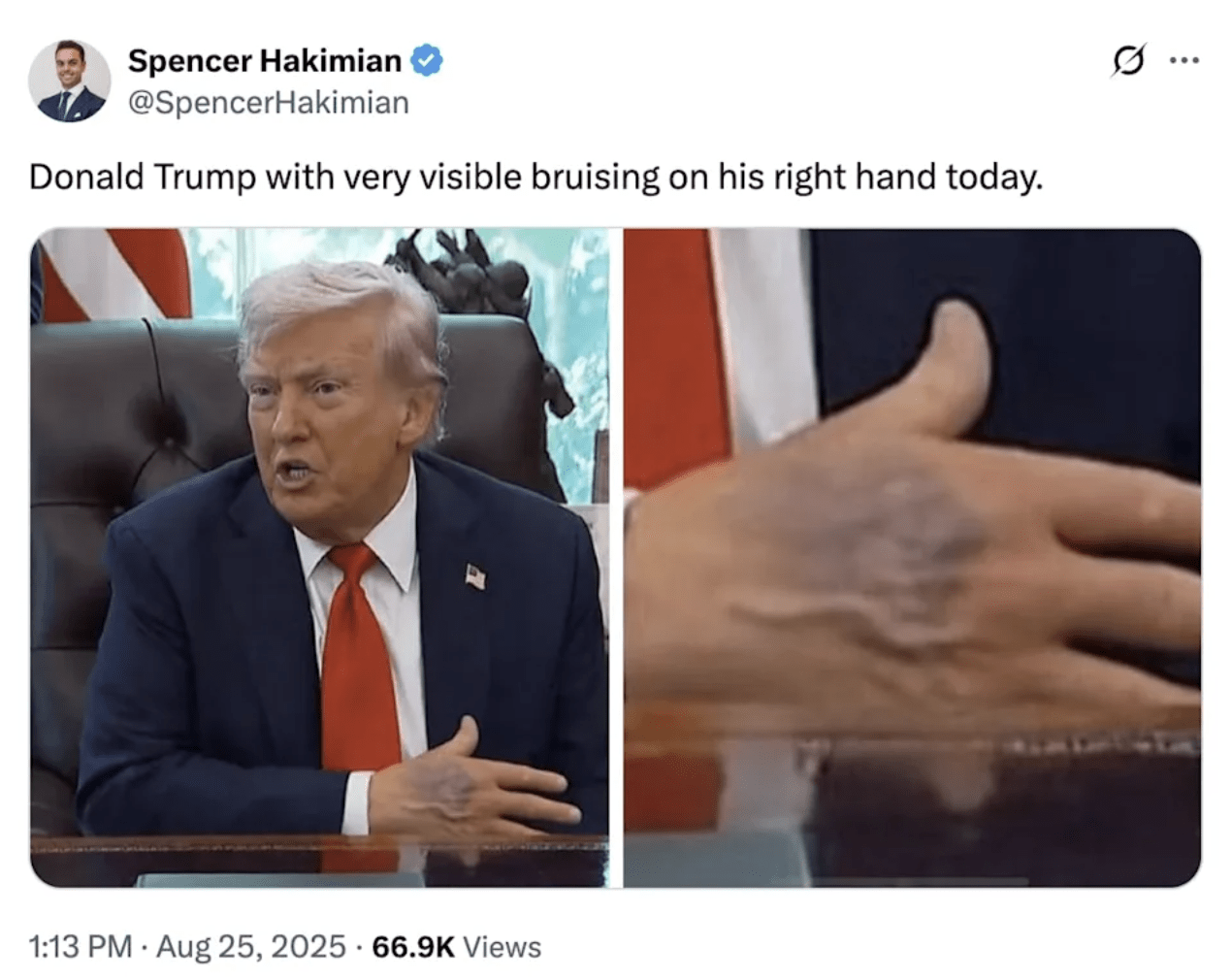 Trump’s Bruised Hand Seen Without Makeup—and It Looks Quite Bad ...